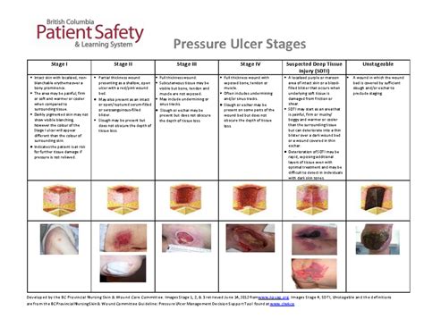 Pressure Ulcer Staging Guide Nhs